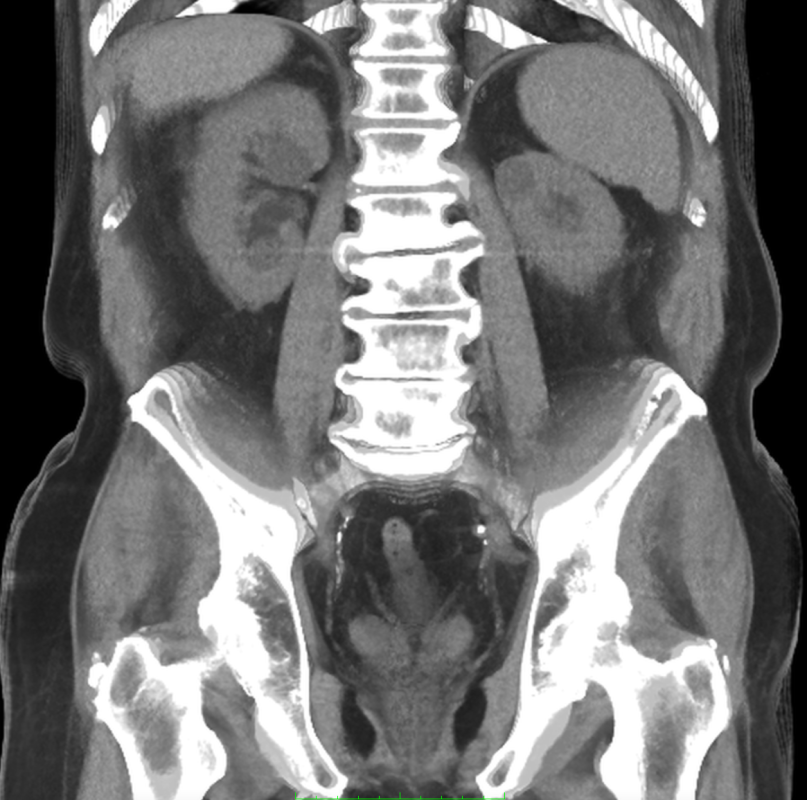 How it works - Bone Density Inc