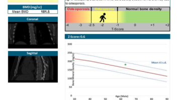 How it works - Bone Density Inc
